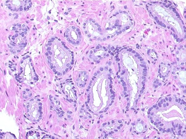 “This is your cancer” | Tissuepathology.com