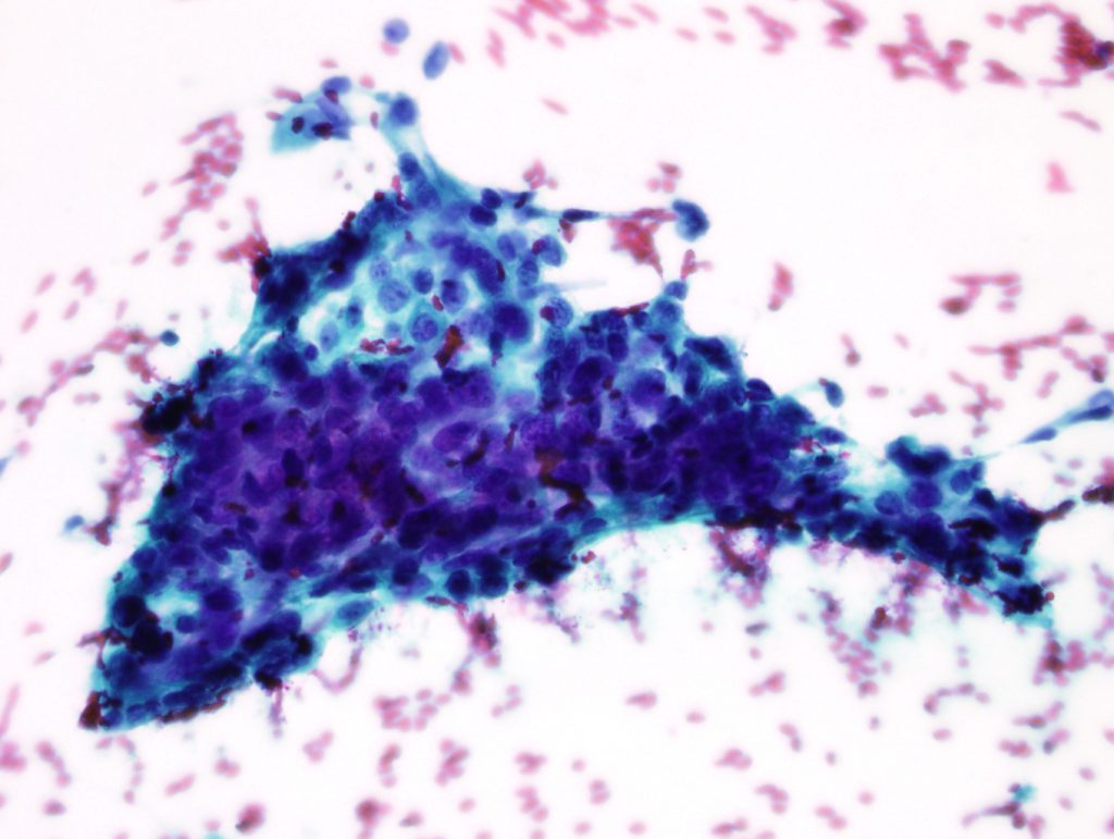 Fine Needle Aspiration (FNA) on Christmas Eve | Tissuepathology.com