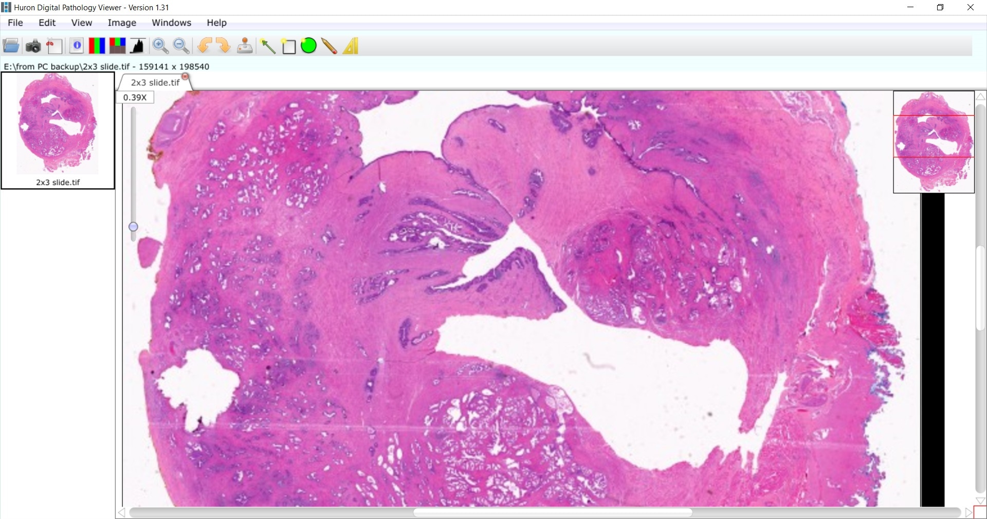 Patient Outcomes of Prostate Cancer with Whole Slide Imaging ...