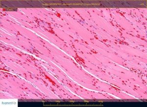 Pathology AI Algorithms Deployed on Augmented Reality Microscope in ...