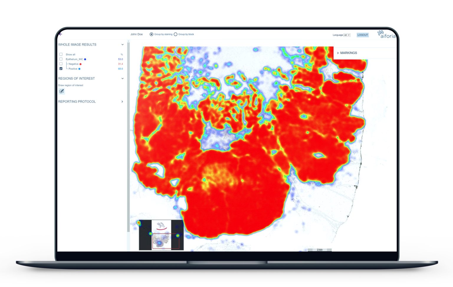 Aiforia: CE-IVD Mark - AI-supported Breast Cancer Diagnostics ...