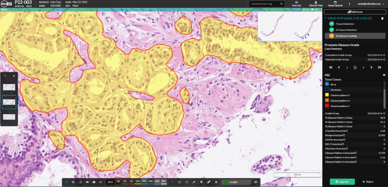 INDICA LABS CE-IVD PROSTATE GLEASON | Tissuepathology.com