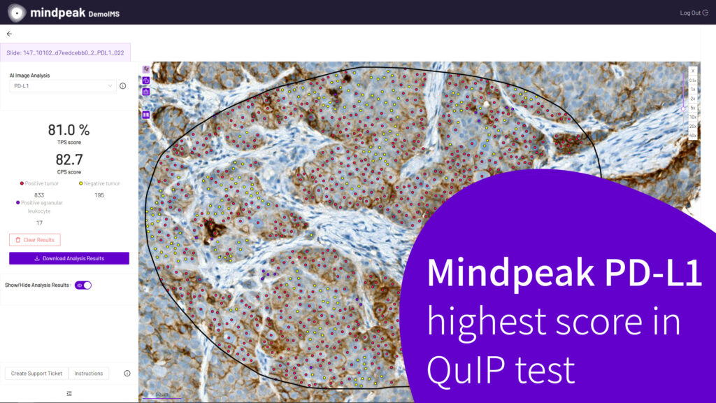 Mindpeak lung cancer diagnosis | Tissuepathology.com