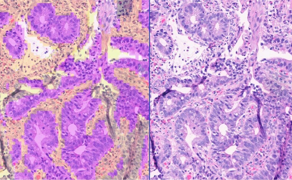 PathAI TumorDetect AI Tumor Assessment | Tissuepathology.com